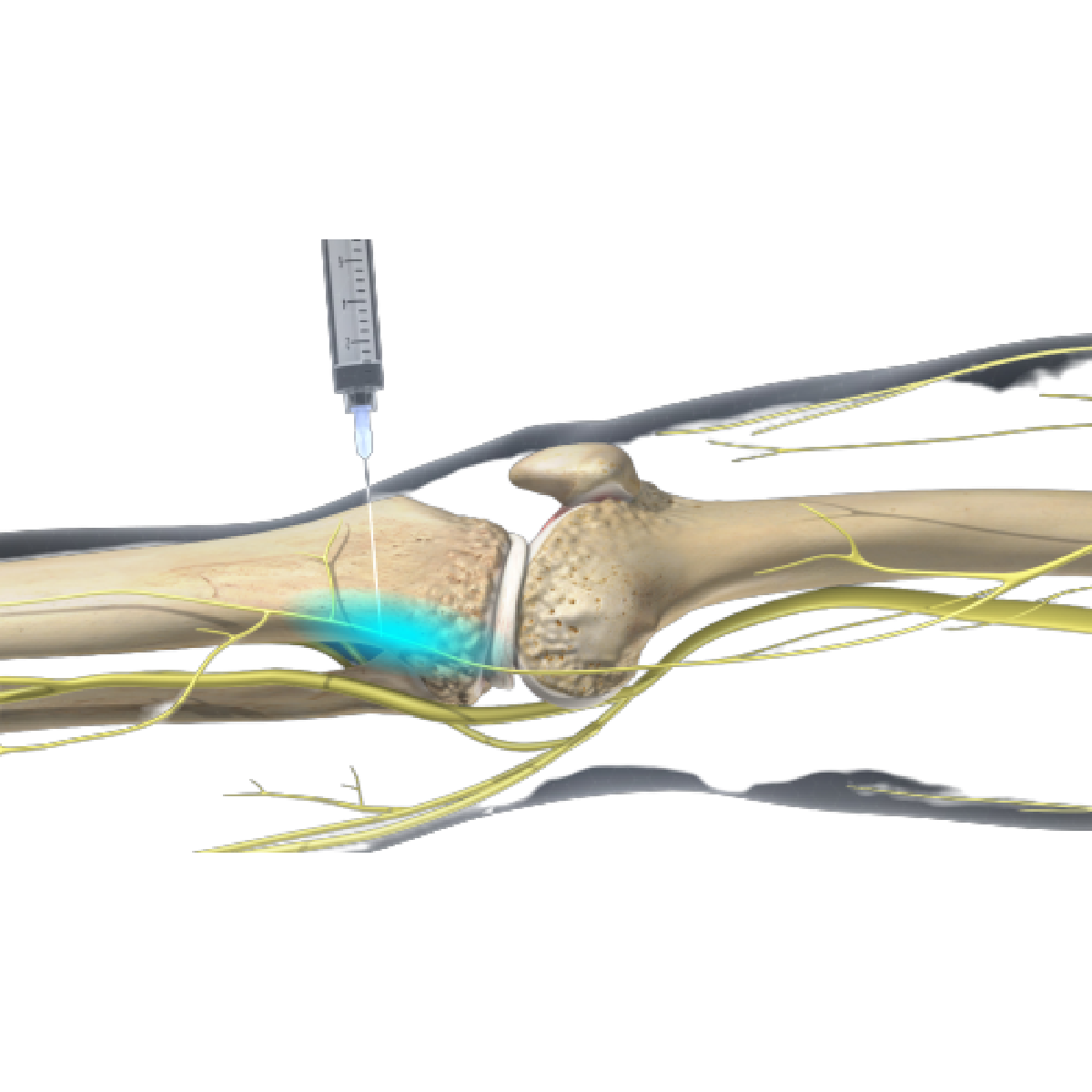 Radiofrequency ablation provides hope for knee pain due to arthritis ...