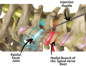 Why you may have severe back and leg pain after RFA (and why not to ...